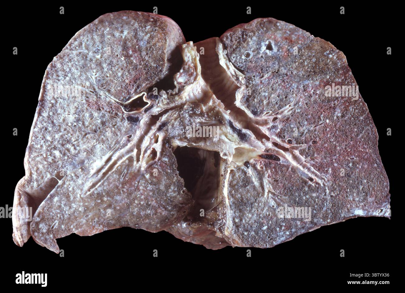 Gross specimen of lungs with miliary tuberculosis. Miliary tuberculosis ...