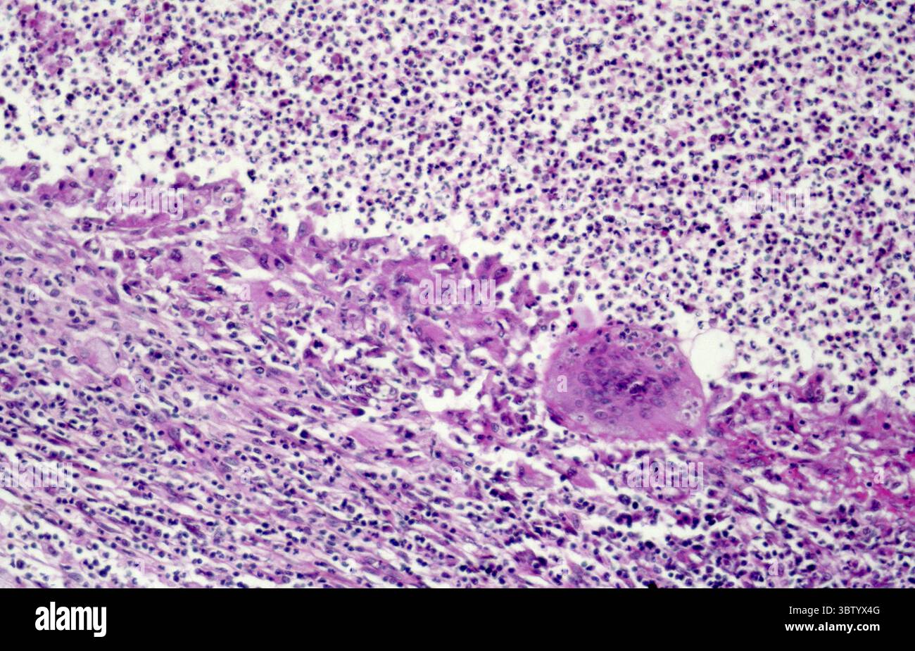 Light micrograph of a section through a lymph node showing an aseptic ...