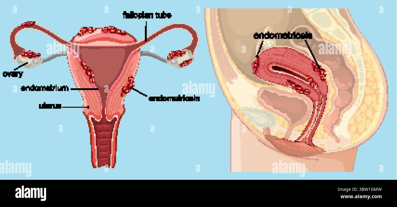 Vector illustration showing endometriosis in the female reproductive system with labeled ...