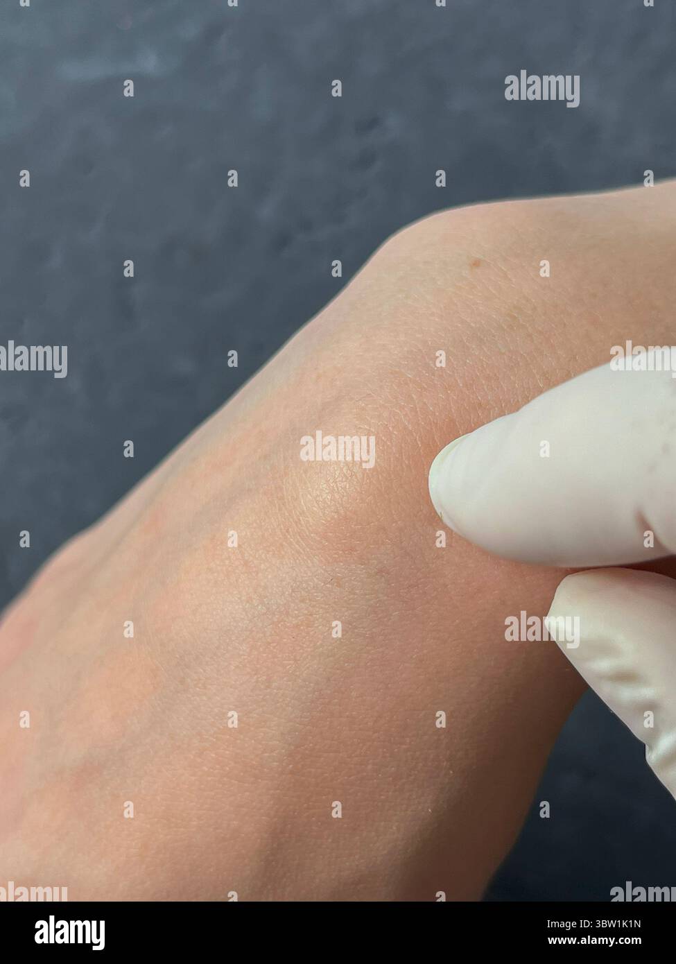 vertical photo Natural female hand shows visible wrist deformation ...