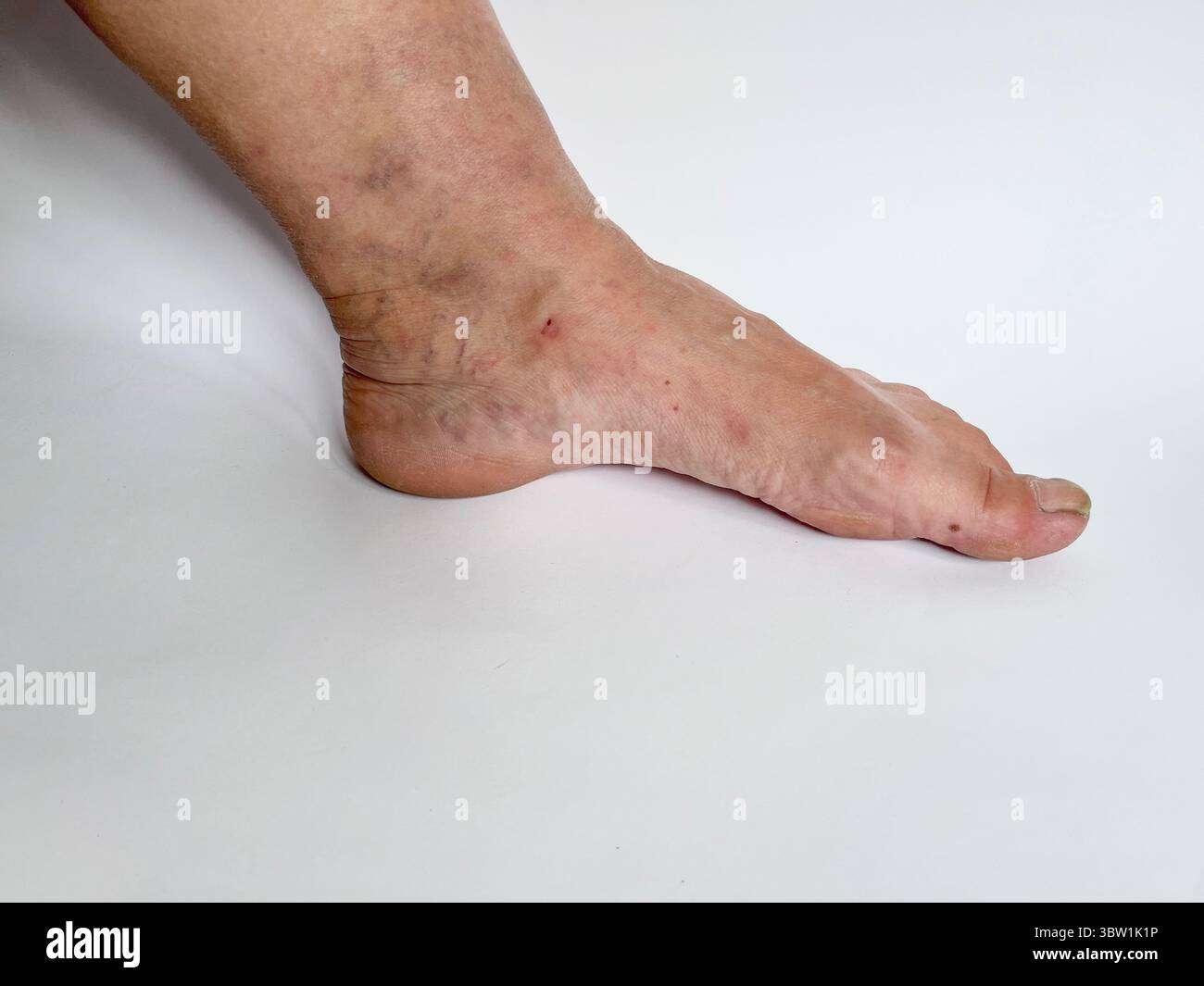 Mild swelling hi-res stock photography and images - Alamy