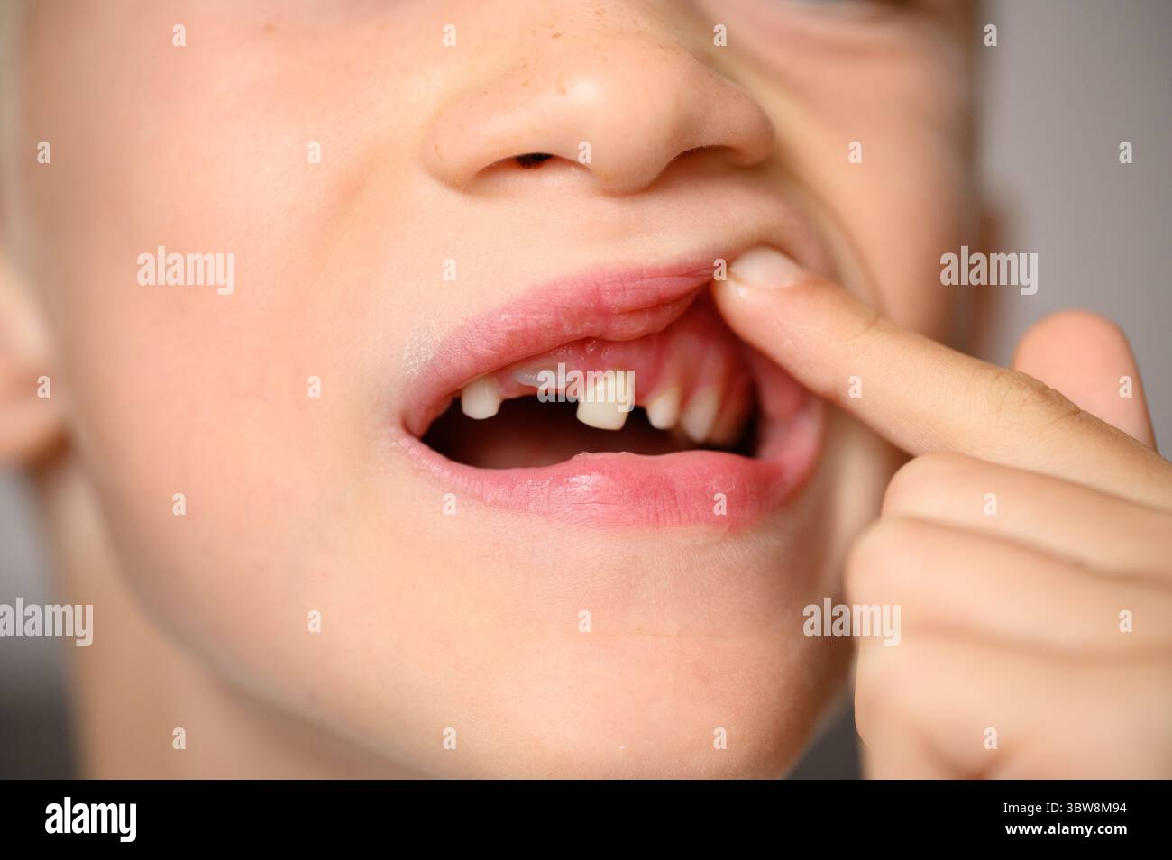 Boy lifts lip with finger, opens mouth to show loose baby tooth and ...