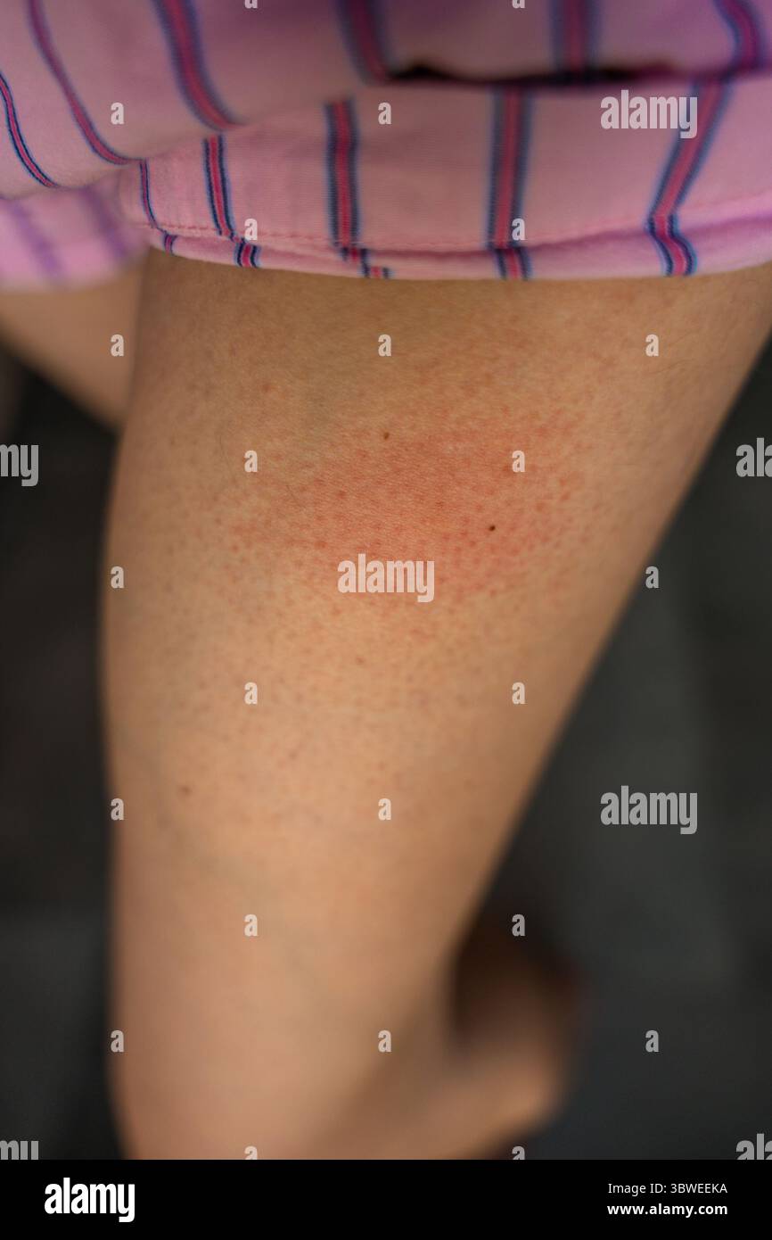 Red swollen spot on womans leg after insect sting or allergic skin ...