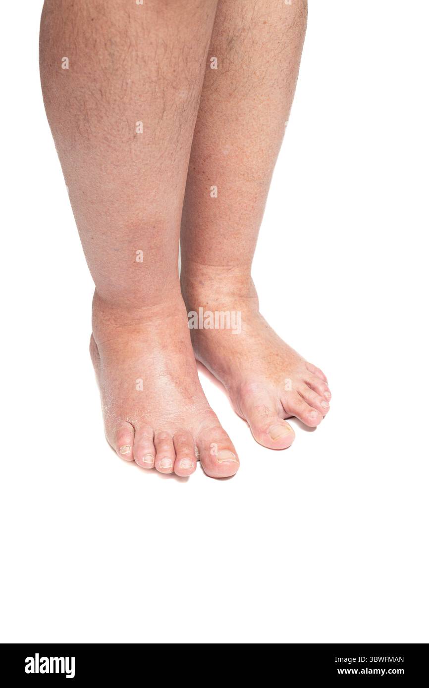 Swollen leg caused by a broken toe. Unrecognizable man with swollen ...