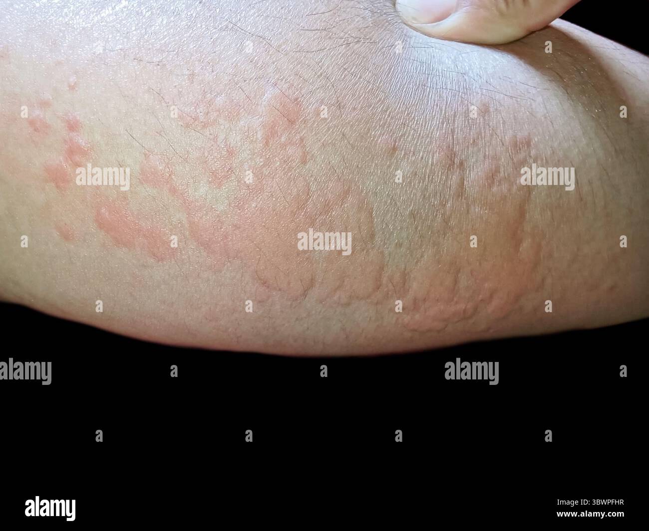 Closeup view of leg skin affected by large urticaria, showing red ...