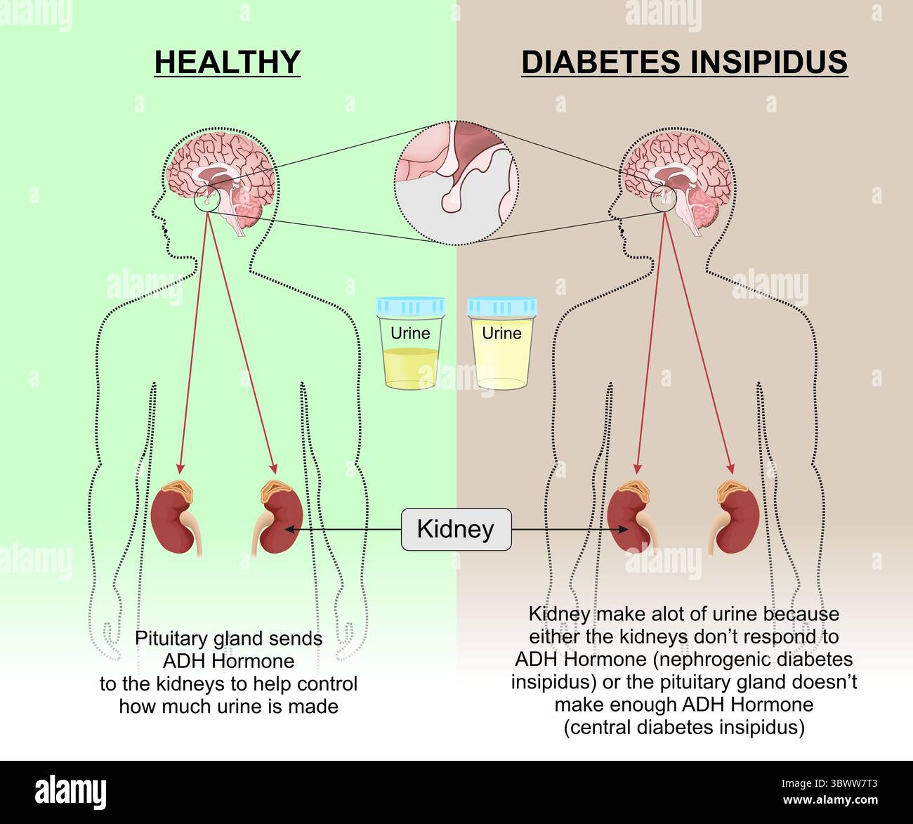 Diabetes insipidus urine illustration Stock Photo - Alamy