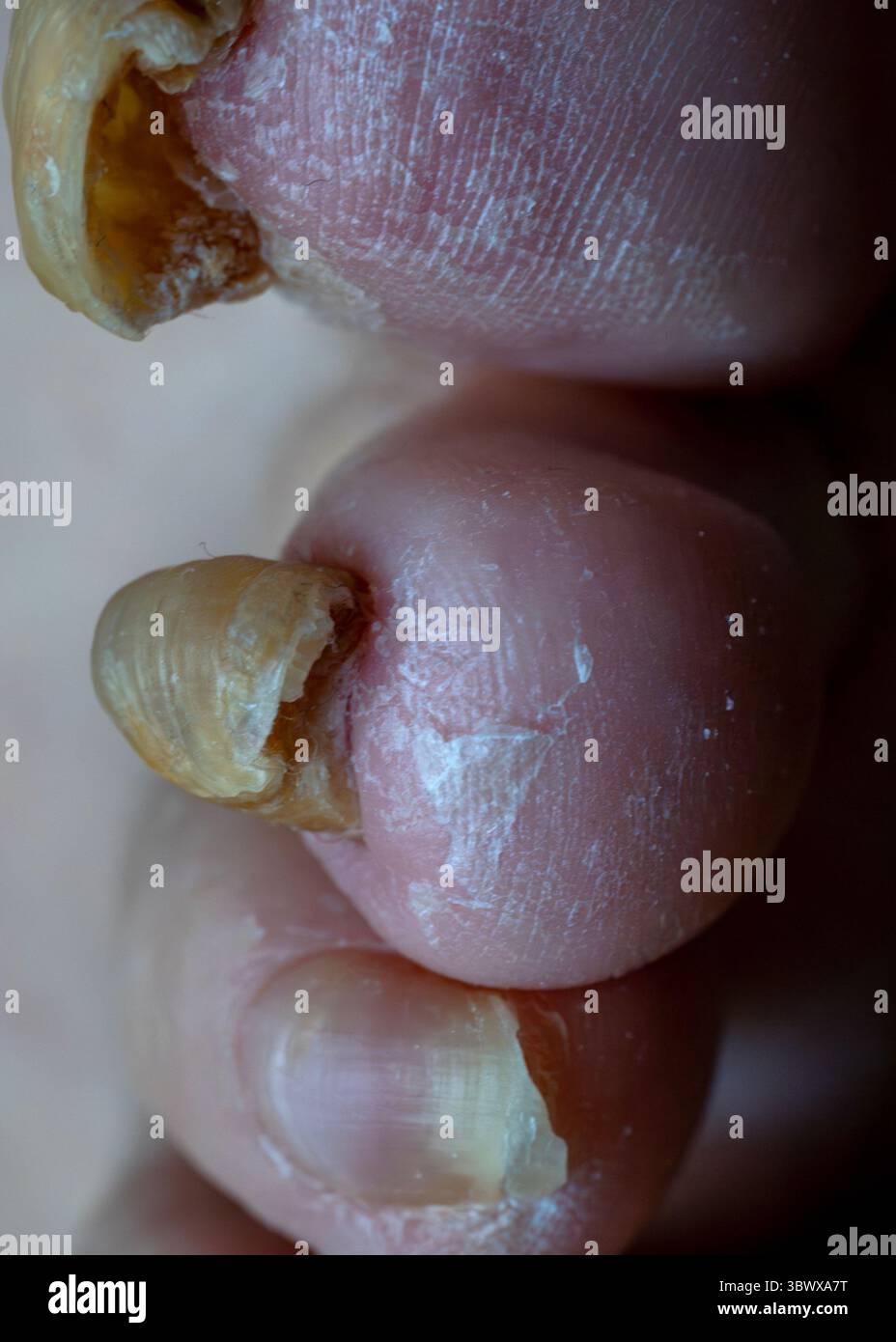 Fungal Toes Infection – Macro Shot with Medical Cream Treatment Stock ...