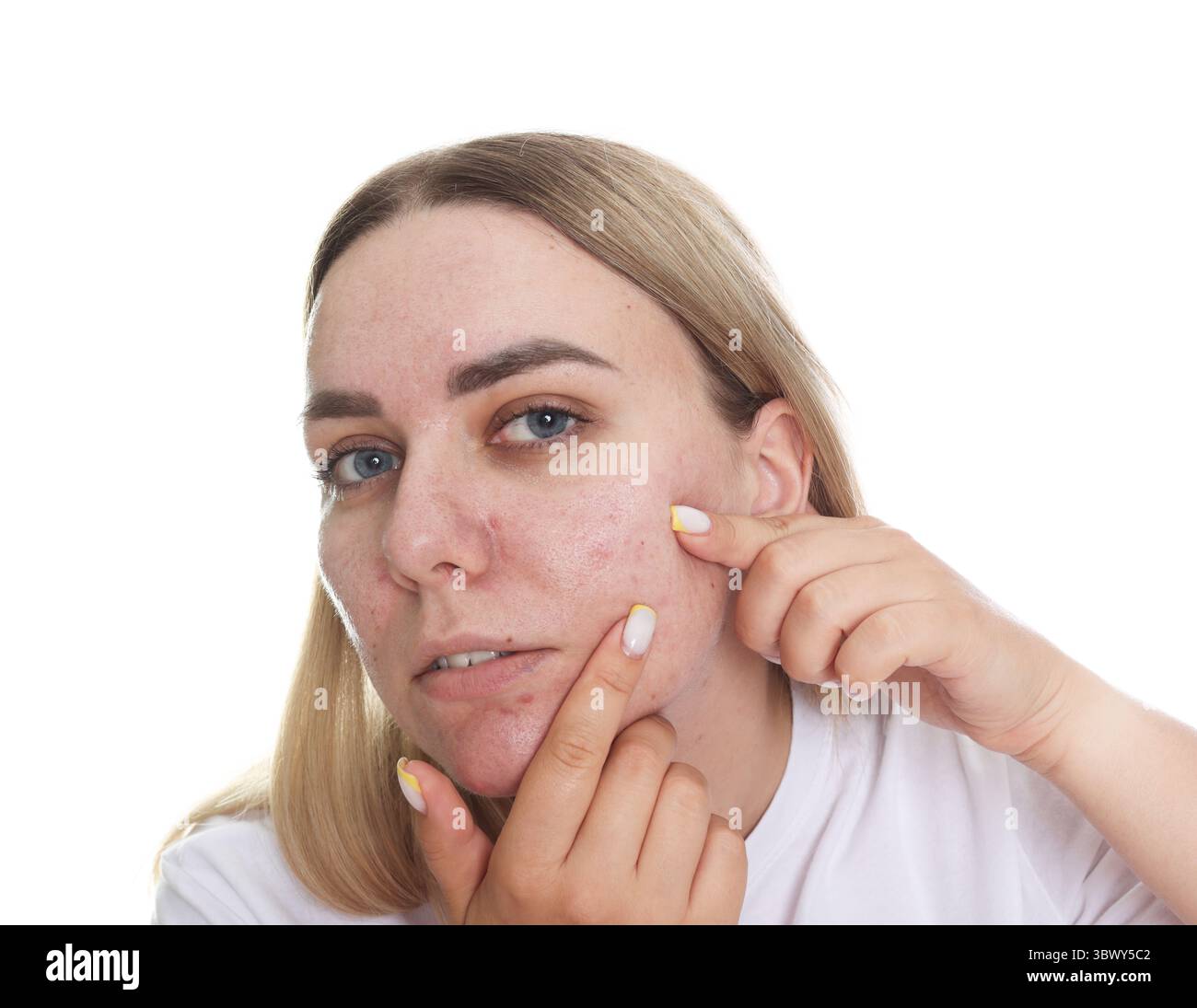 Woman with acne problem on white background Stock Photo - Alamy