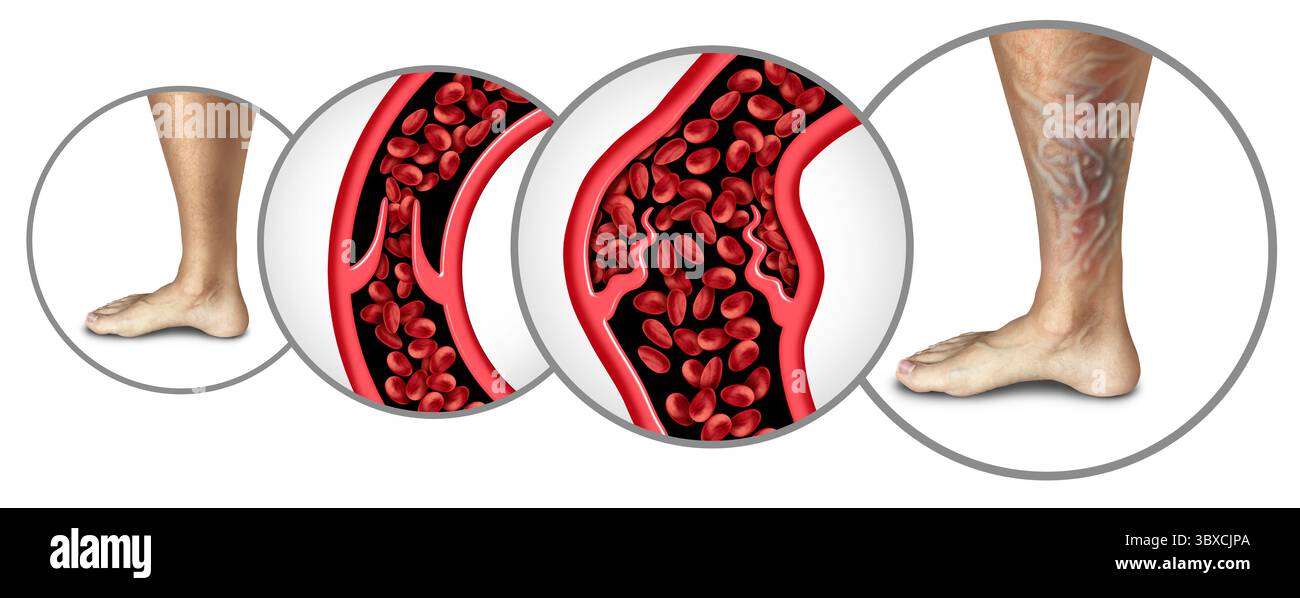 Deep venous insufficiency hi-res stock photography and images - Alamy