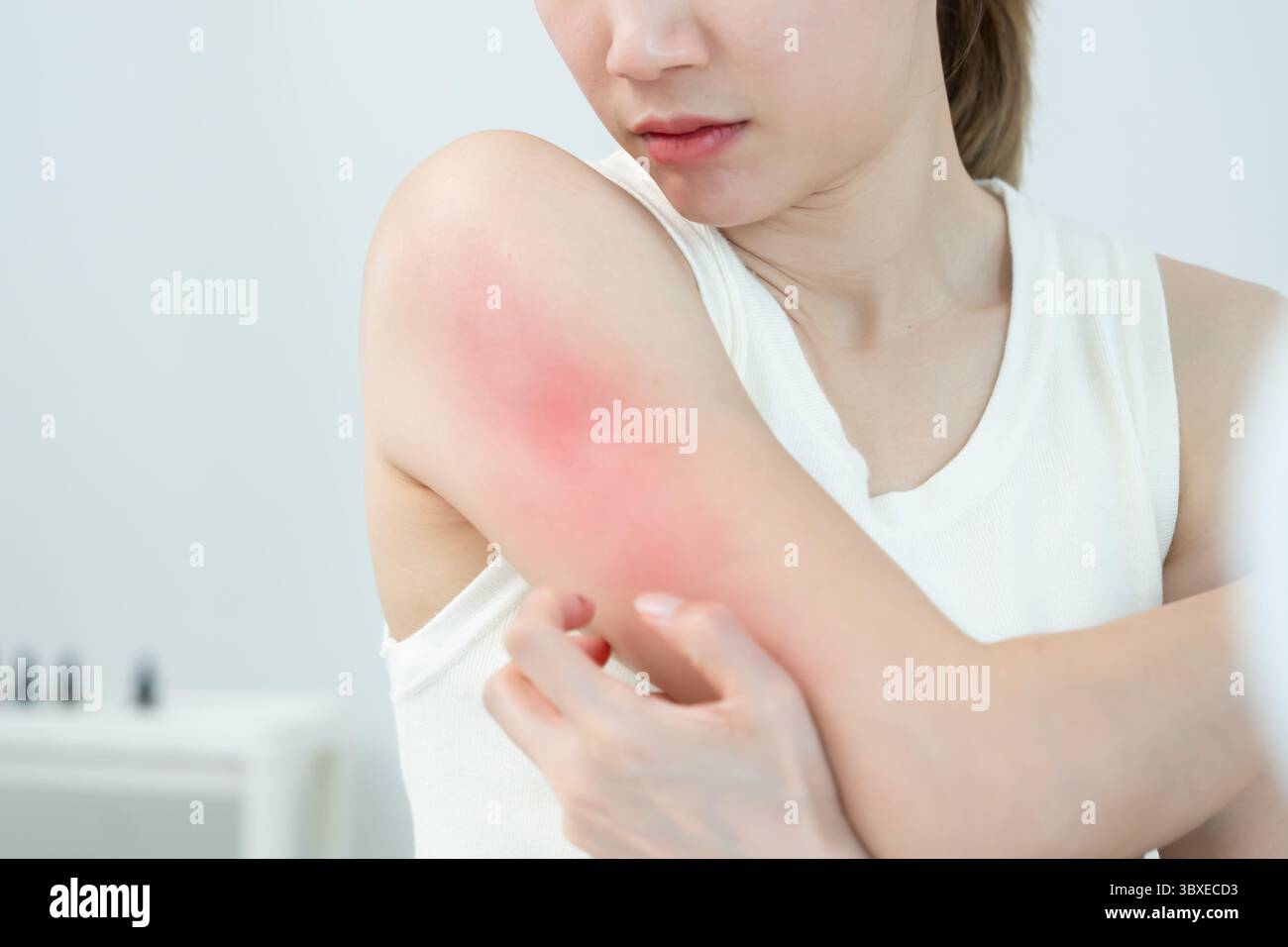 skin problem and beauty. Young woman scratch body has itchy skin from ...