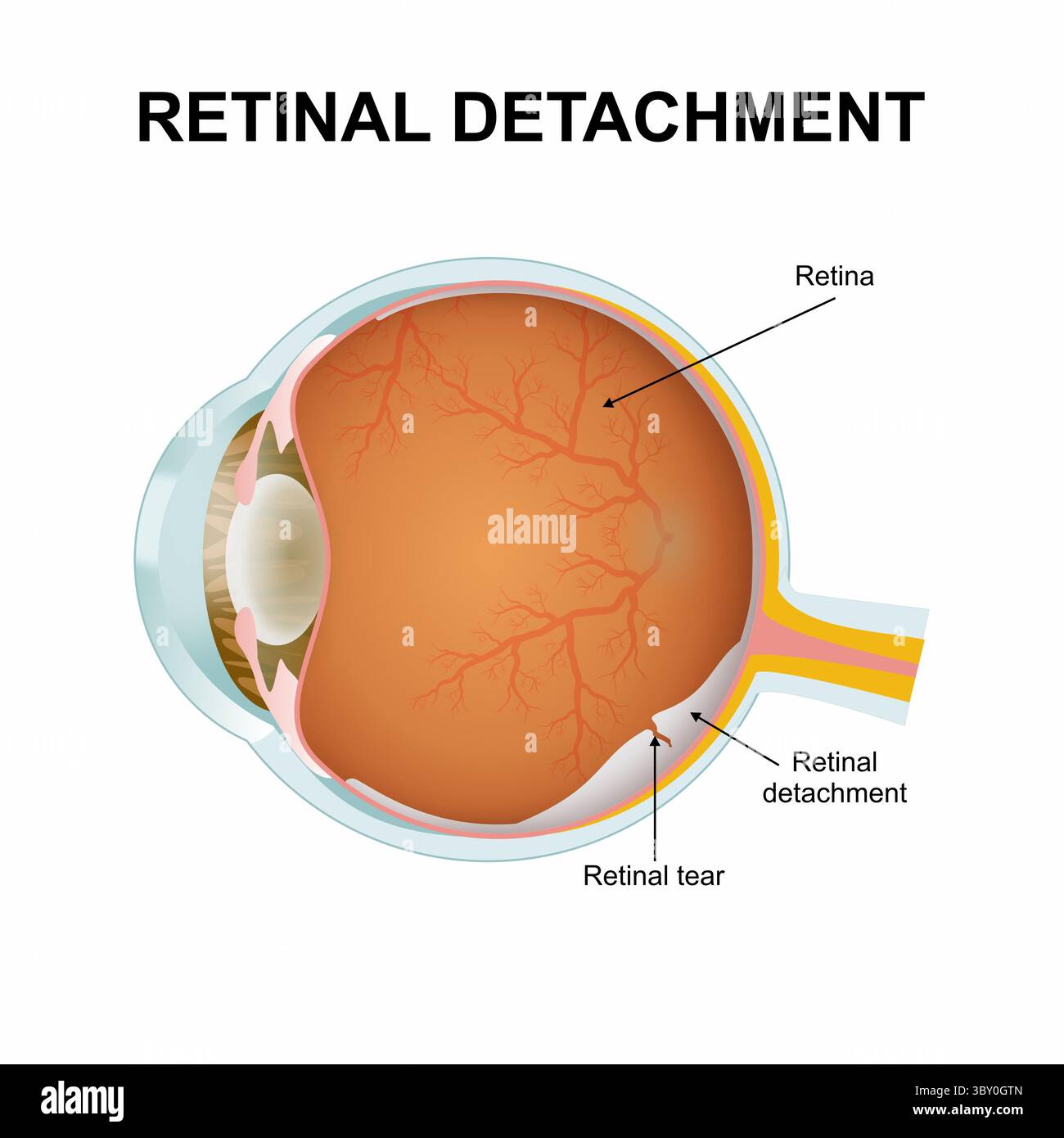 Retinal Detachment Cross-section illustration Stock Photo - Alamy