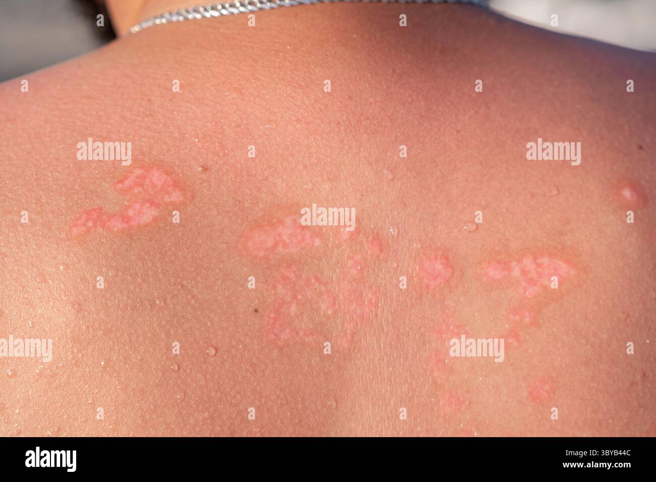 Red inflamed patches psoriasis hi-res stock photography and images - Alamy