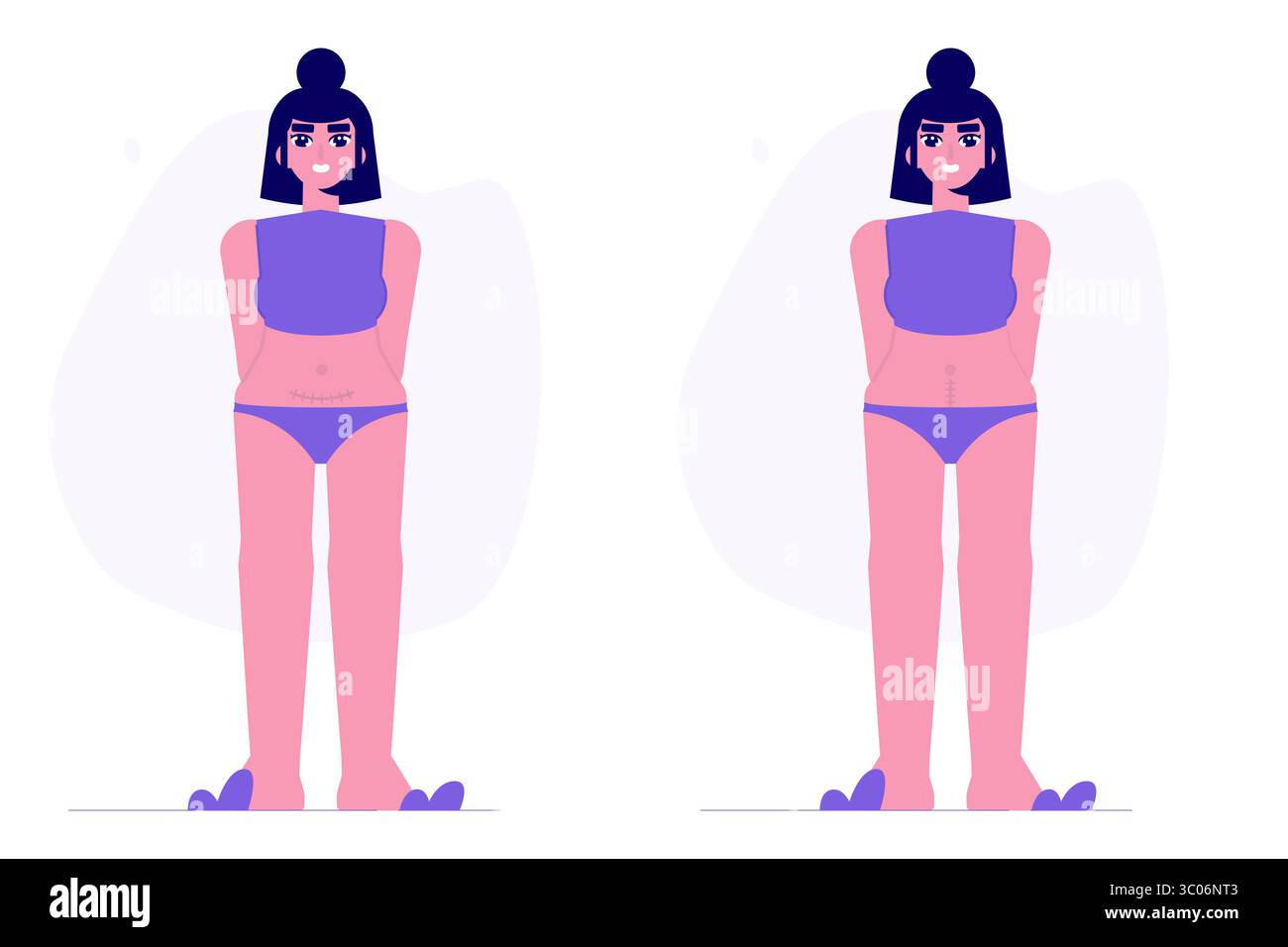 Appendix scar Stock Vector Images - Alamy