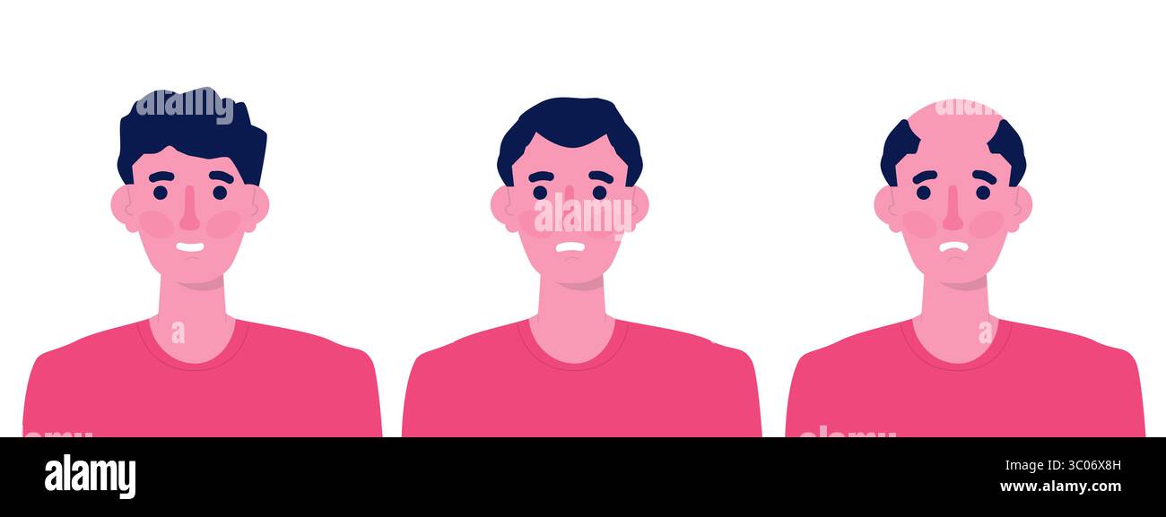 Hair stages loss. Types of baldness on male head vector Stock Vector ...