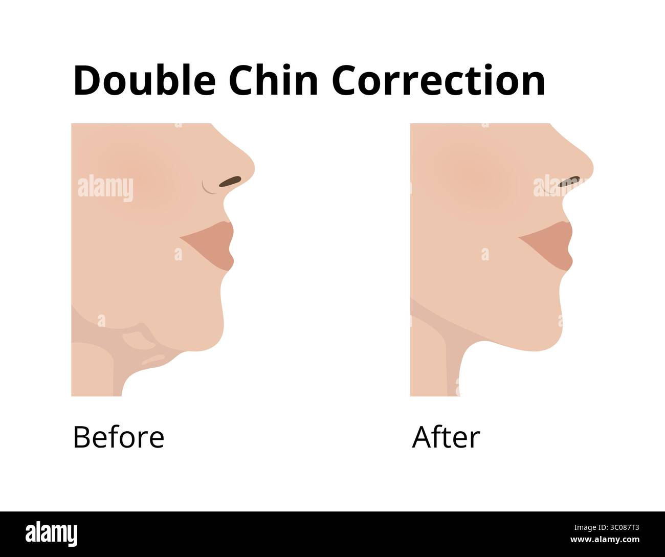Woman profile highlighting transformation before and after double chin ...