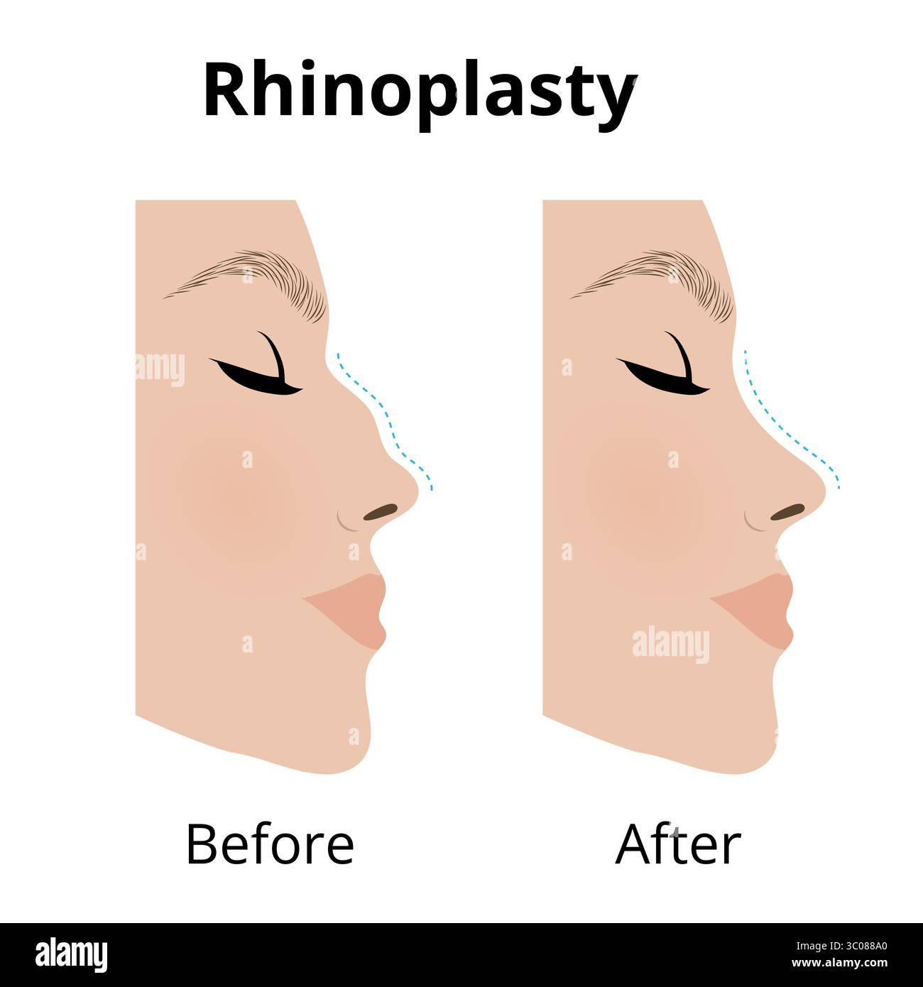 Rhinoplasty vector vectors Cut Out Stock Images & Pictures - Alamy