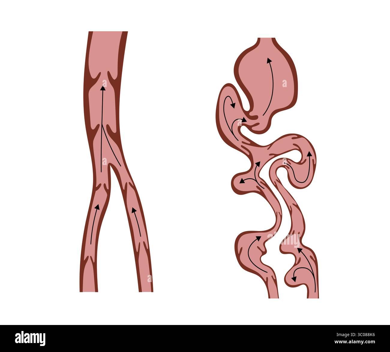 Medical illustration comparing healthy blood flow in normal veins with ...