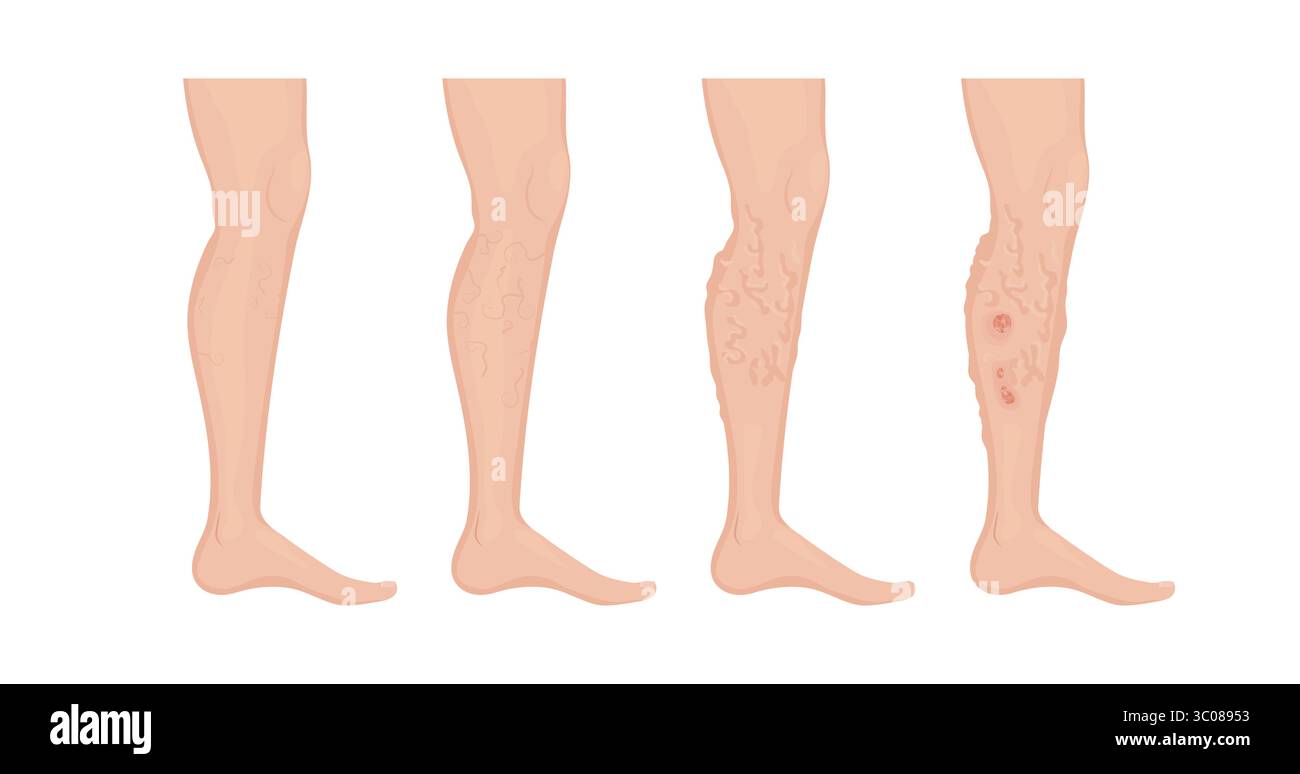 Stages of varicose veins developing on human leg Stock Vector Image ...