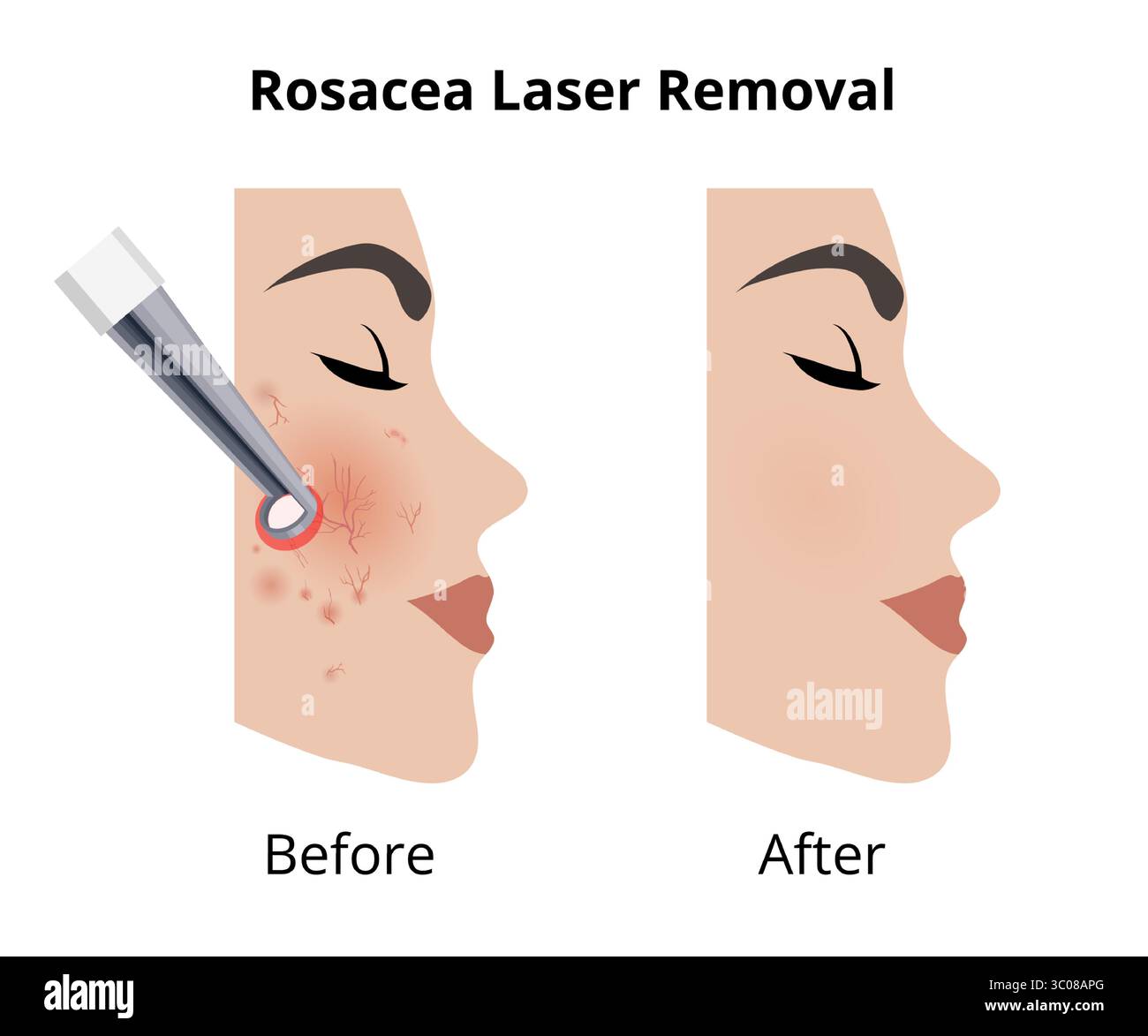 Before after rosacea laser hi-res stock photography and images - Alamy