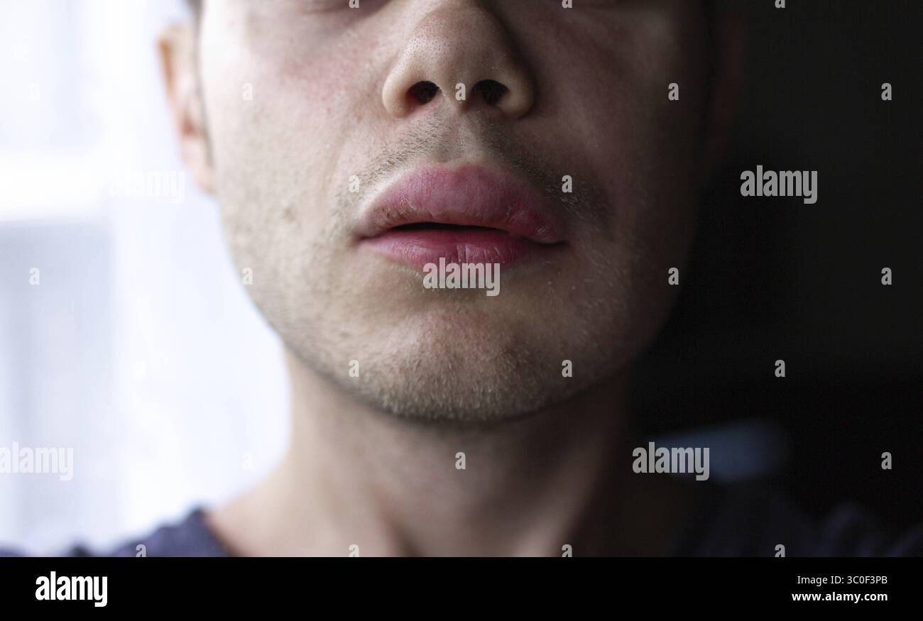Close-up of facial features with lips showing swelling in natural light ...
