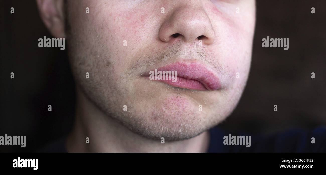 Close-up of a person's lips and chin showing uneven swelling Stock ...
