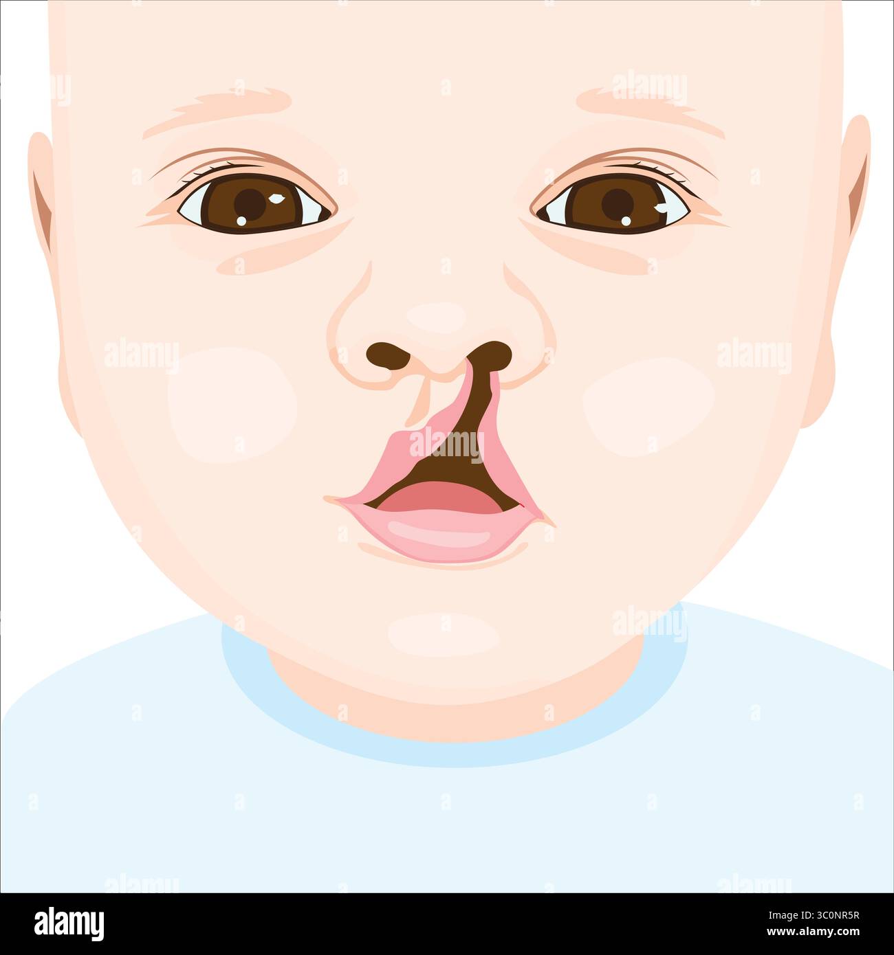 illustration of a cleft palate in a child. plastic surgery ...