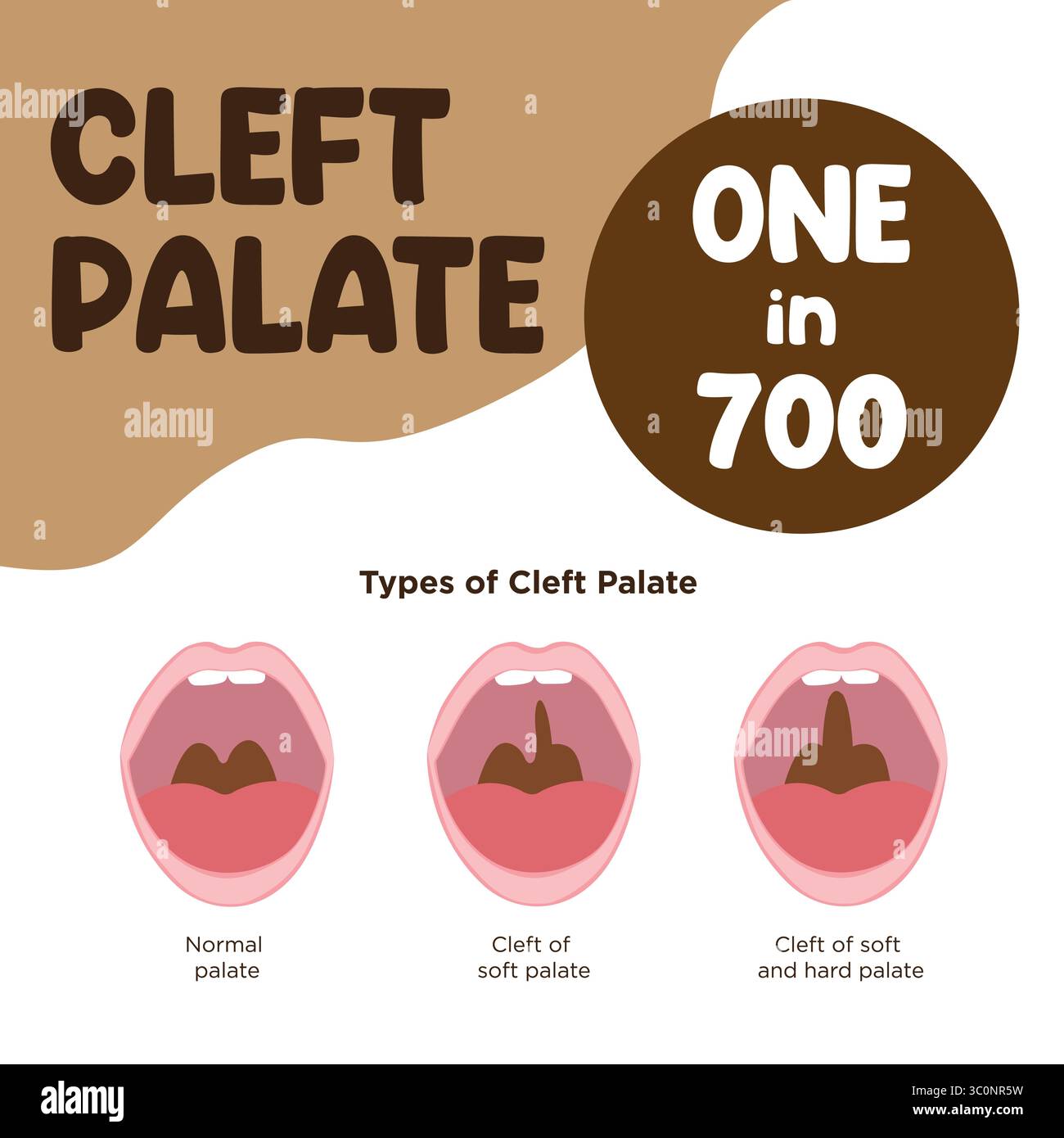 Normal, unilateral cleft lip and palate, and bilateral cleft lip and palate conditions in ...