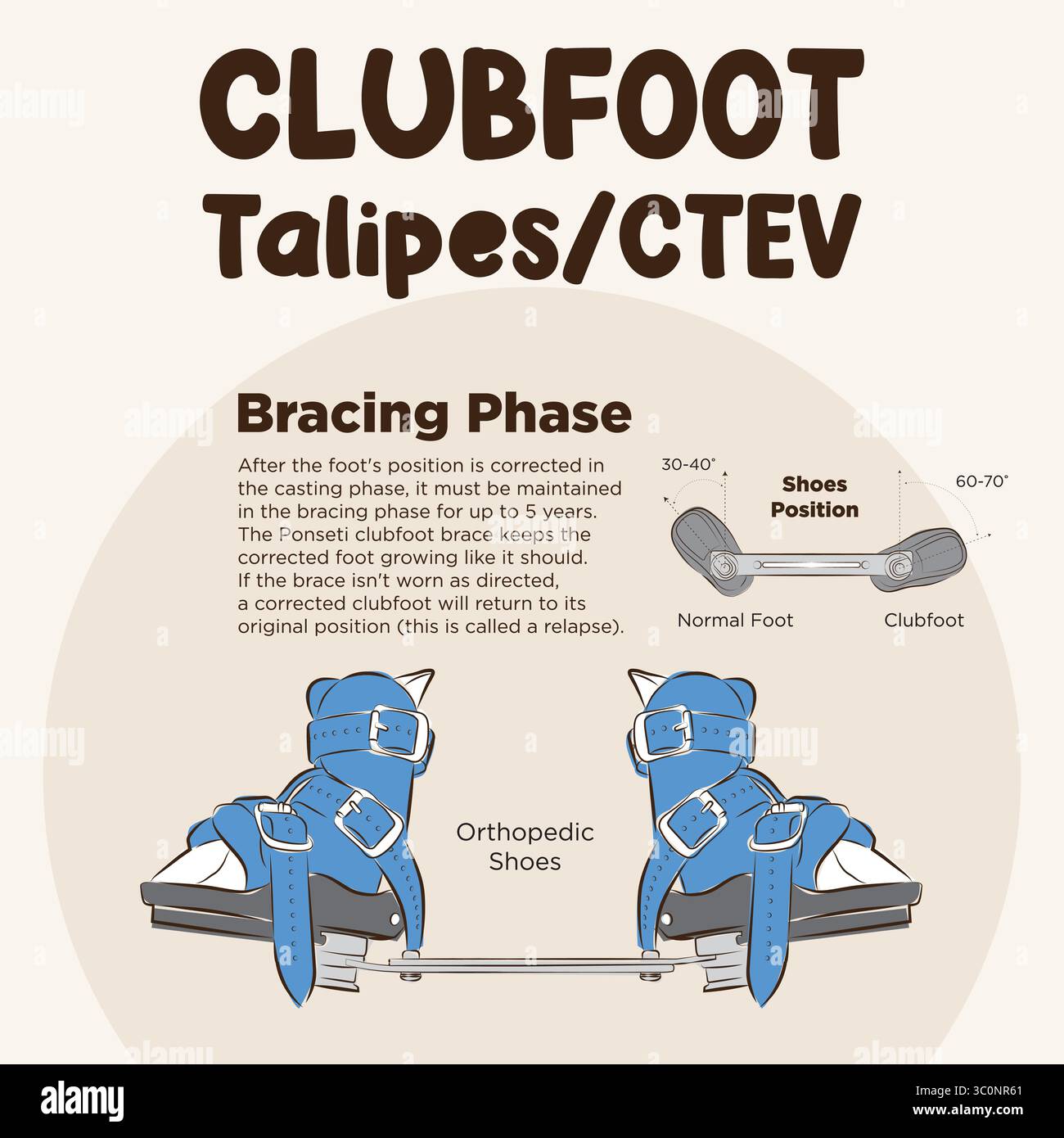 Line art vector of clubfoot boots and bar. Ponseti Method. Clubfoot ...