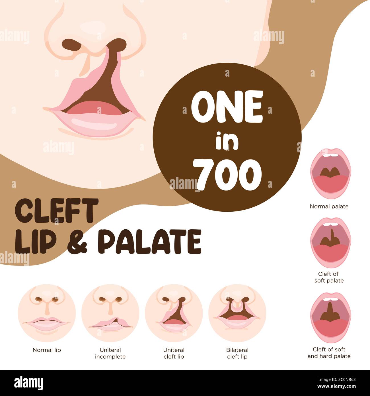 Normal, unilateral cleft lip and palate, and bilateral cleft lip and palate conditions in ...