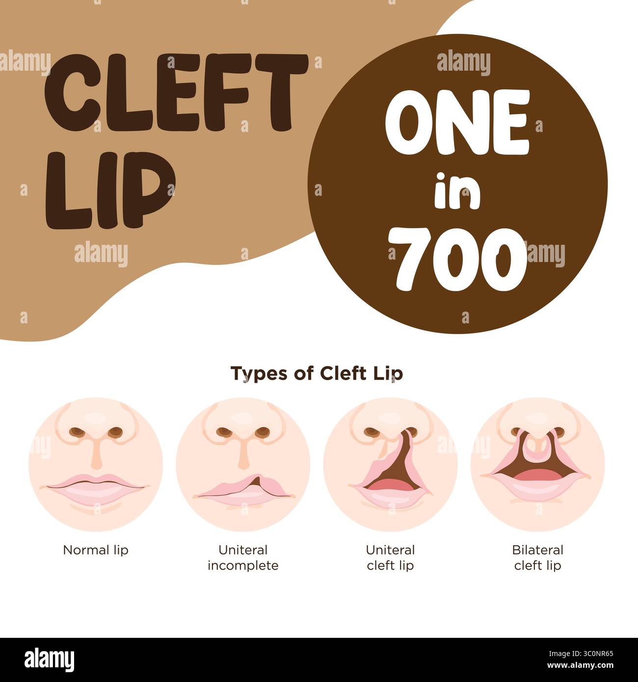 Normal, unilateral cleft lip and palate, and bilateral cleft lip and palate conditions in ...