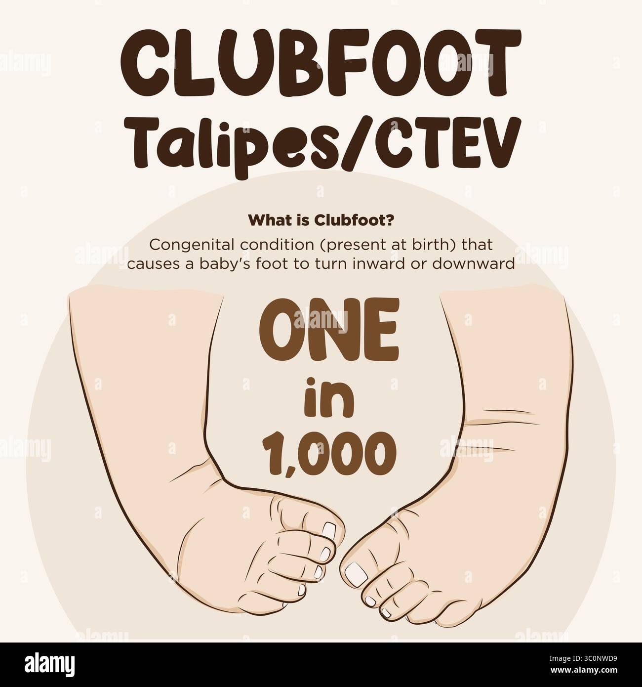 Line art vector of clubfoot. Foot turn inward or upward. Type of ...