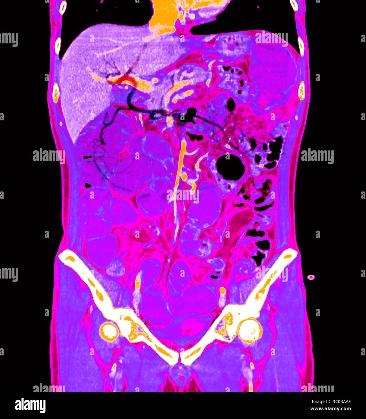 High-resolution abdominal CT image highlighting vascular and organ anatomy with intense color ...
