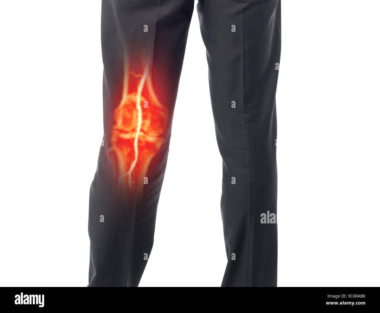 The Vivid CTA femoral artery run off showing femoral artery at knee ...