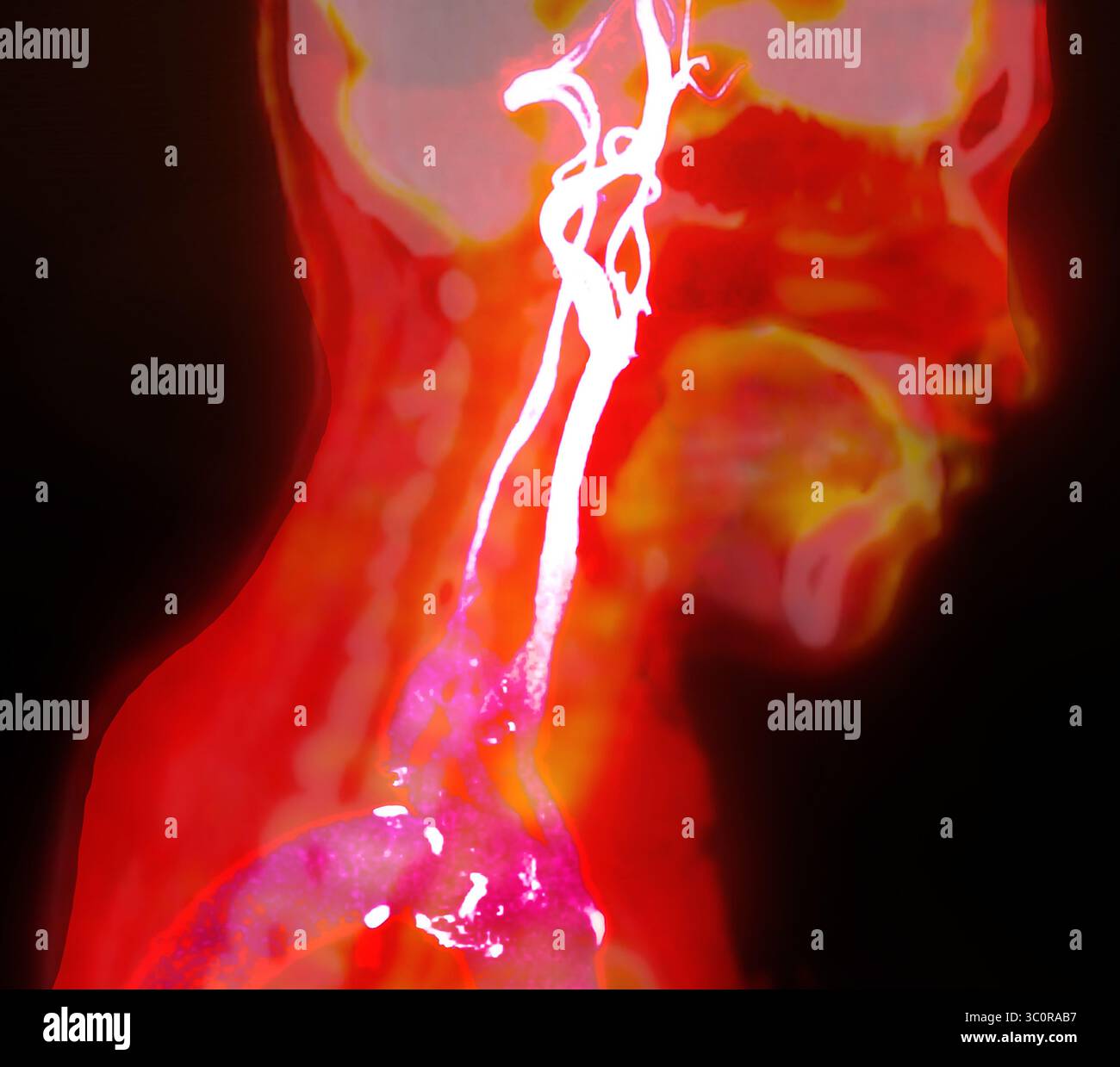 Vivid MRA scan reveals symmetrical flow of blood through the neck's ...