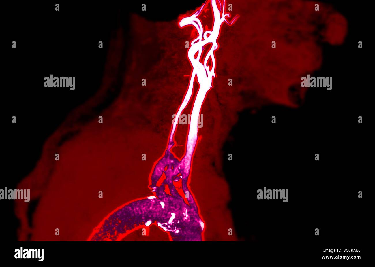 Vivid MRA scan reveals symmetrical flow of blood through the neck's ...