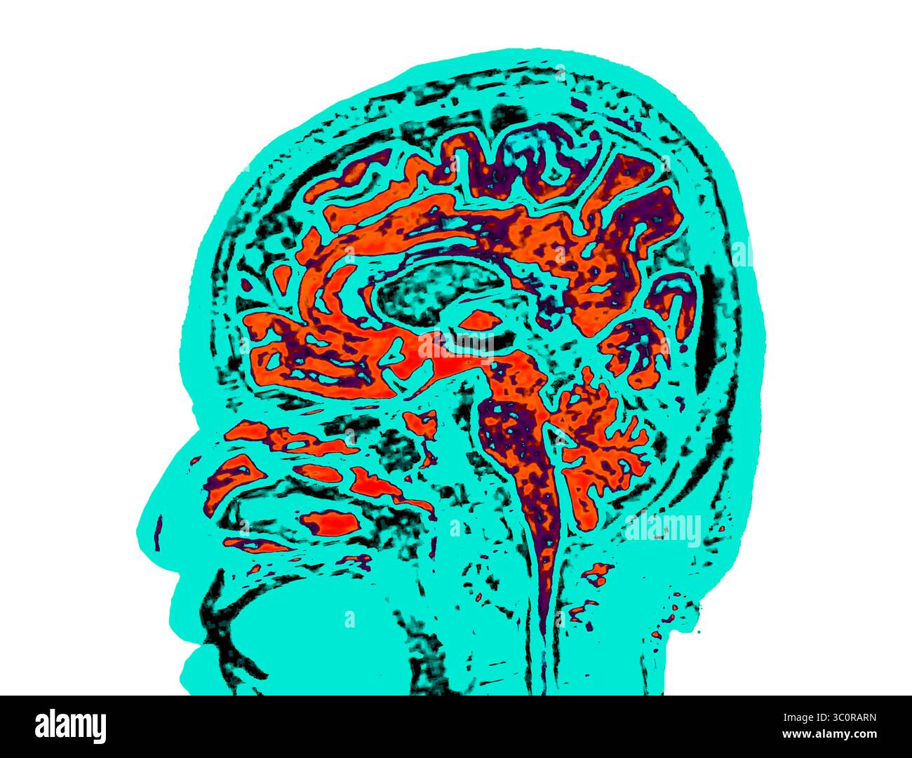 The color-enhanced MRI reveals the brain’s anatomy in striking hues. It ...