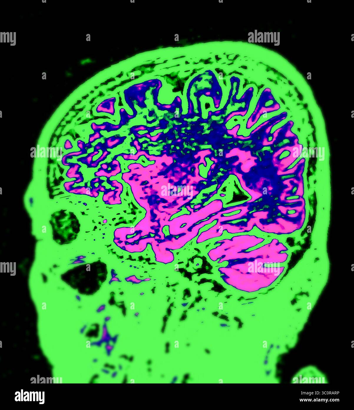 The color-enhanced MRI reveals the brain’s anatomy in striking hues. It ...