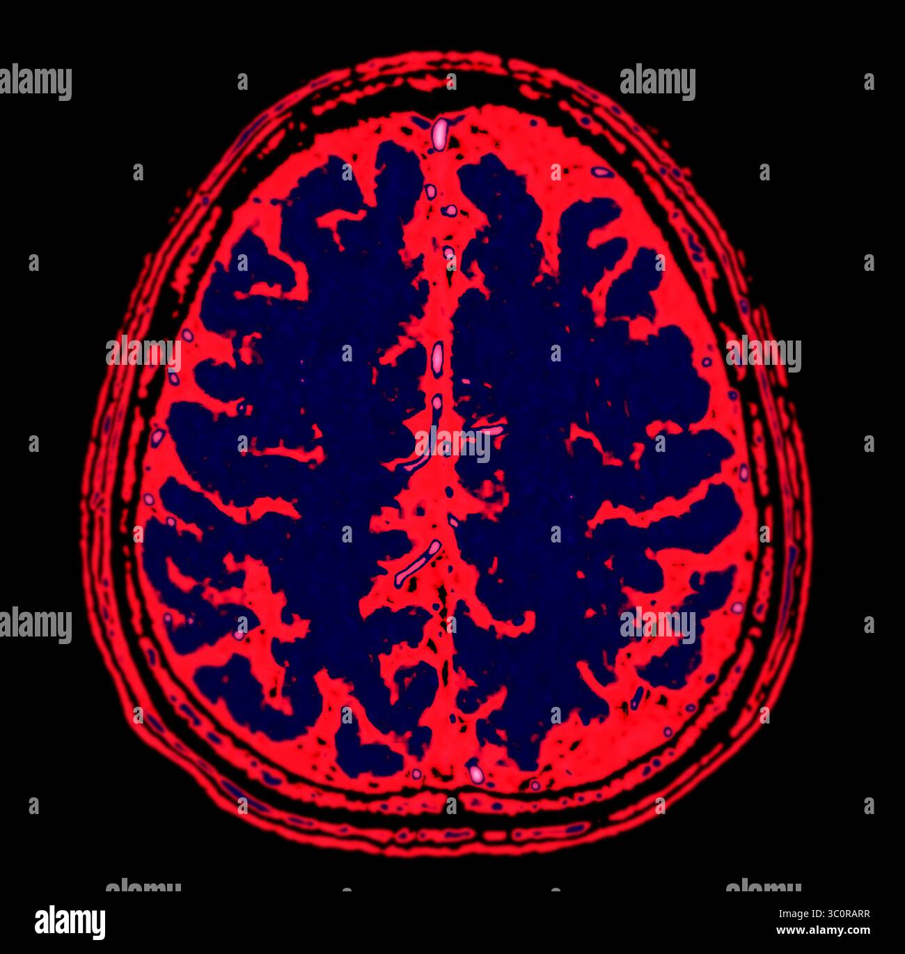 The color-enhanced MRI reveals the brain’s anatomy in striking hues. It ...