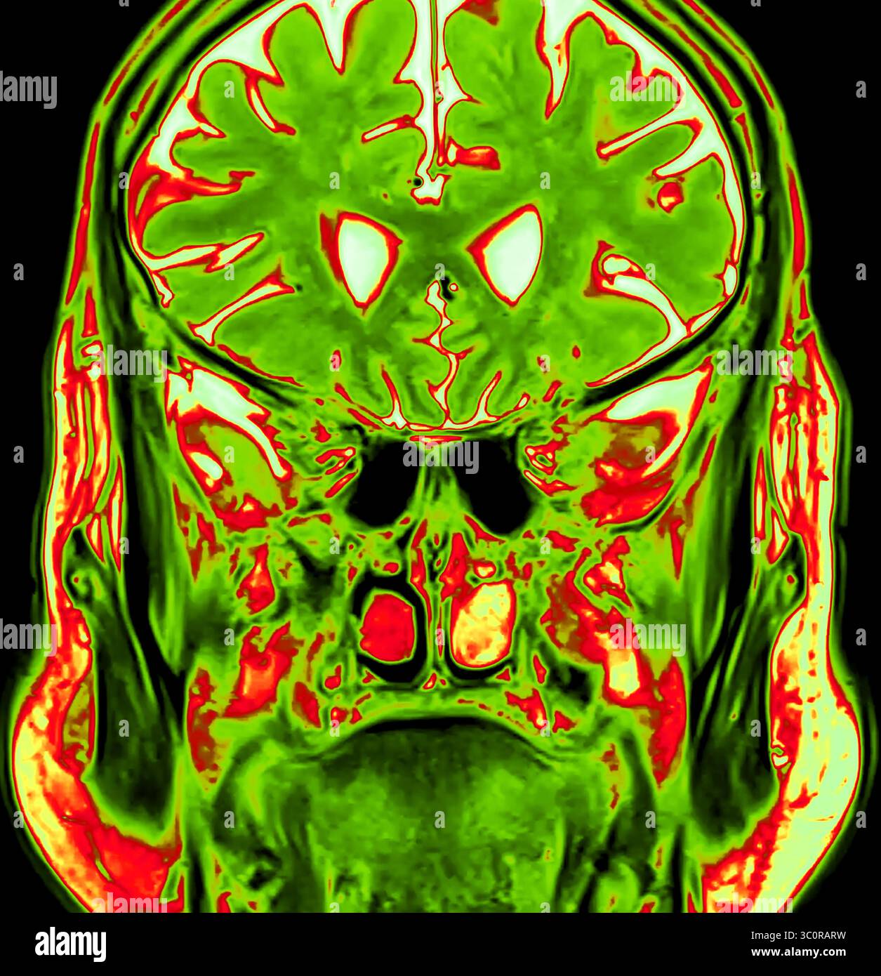 The color-enhanced MRI reveals the brain’s anatomy in striking hues. It ...