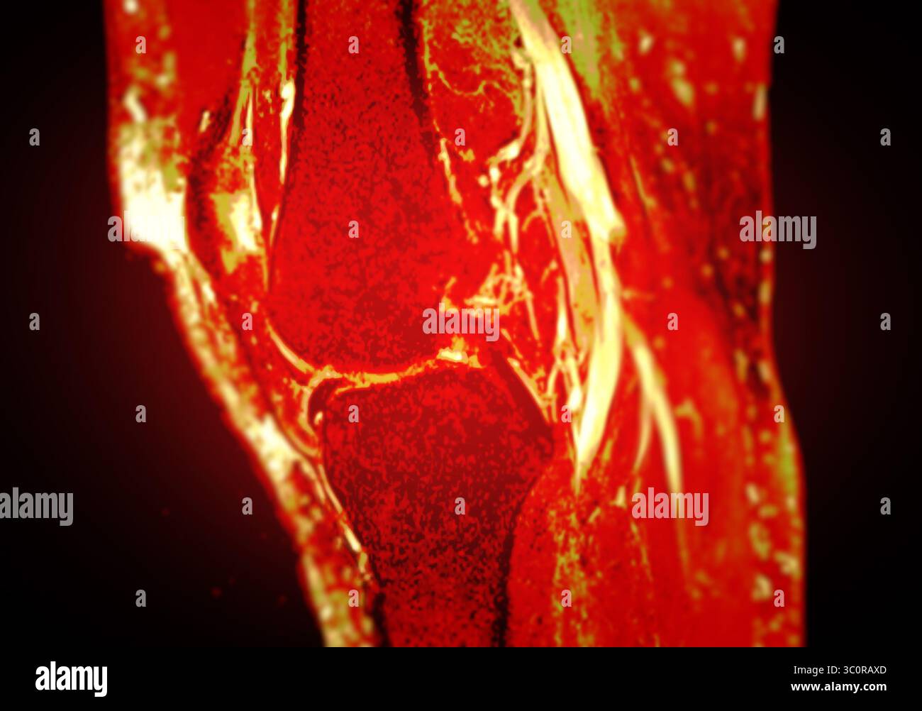 MRI knee or Magnetic resonance imaging of knee joint sagittal view for ...
