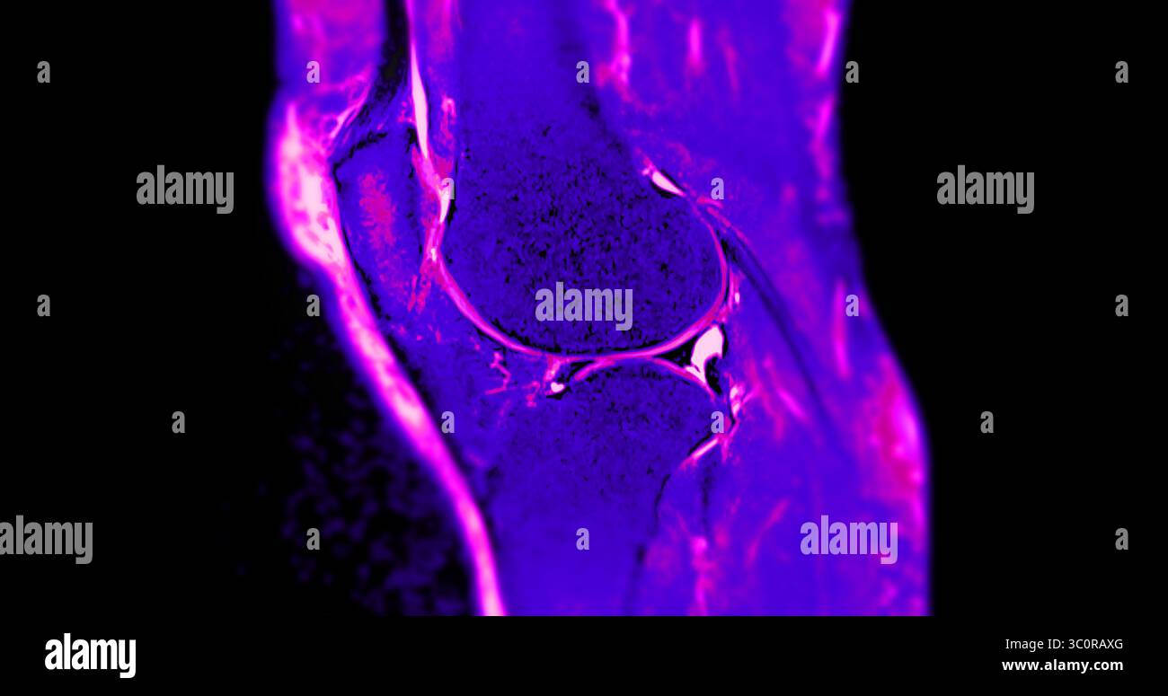 MRI knee or Magnetic resonance imaging of knee joint sagittal view for ...