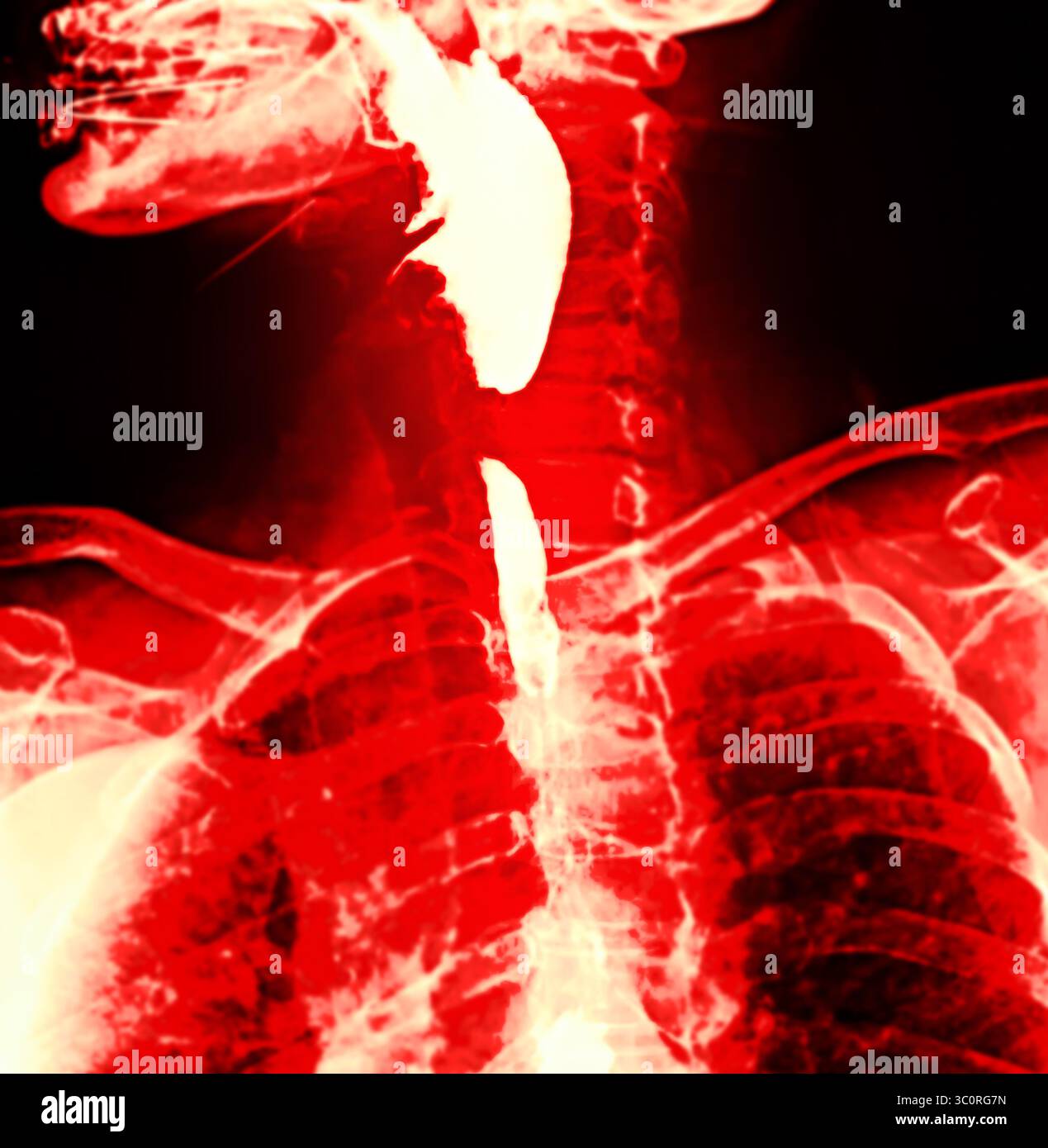 Fluoroscopic footage of a barium swallow test showing real-time ...