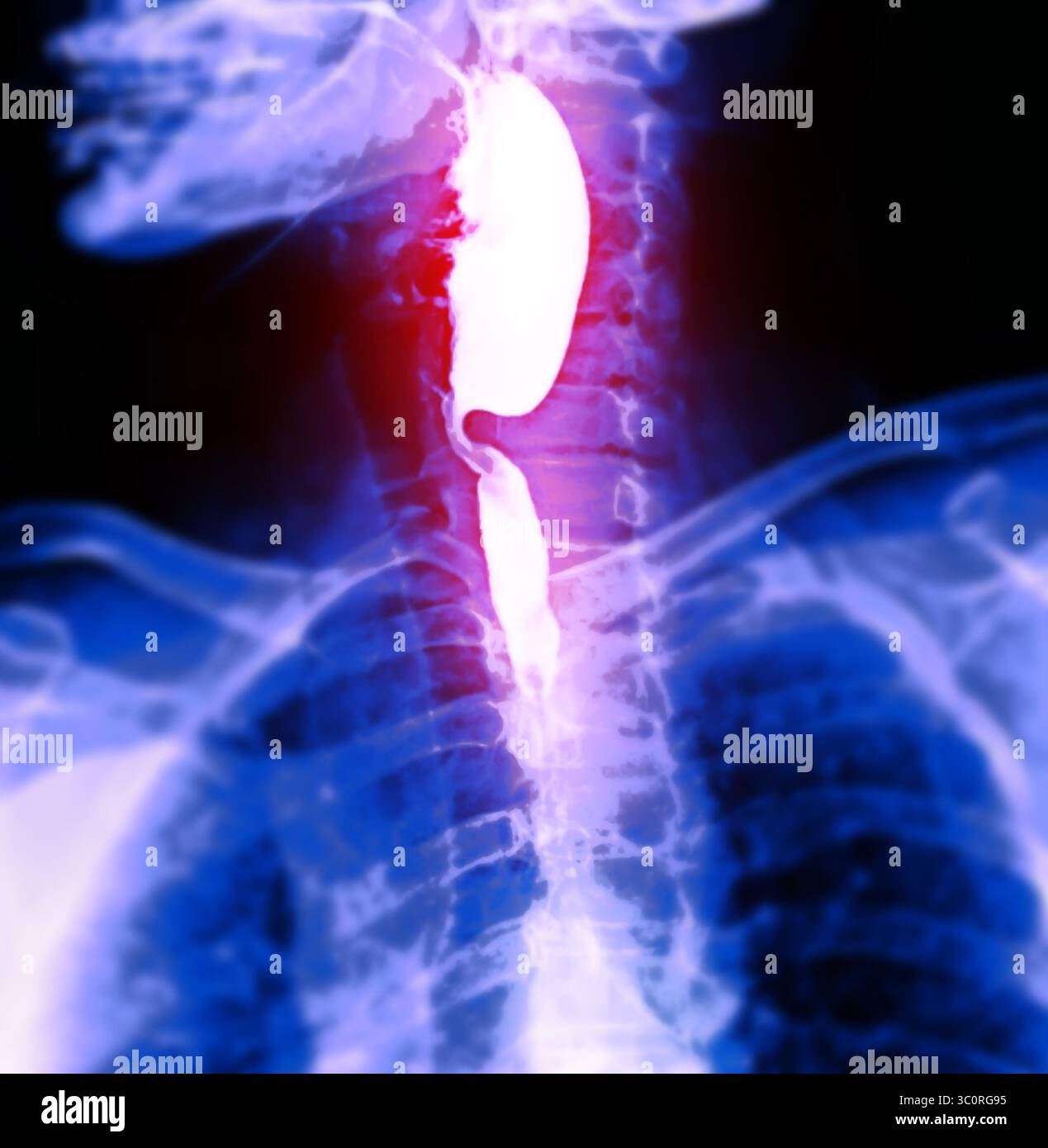 Fluoroscopic footage of a barium swallow test showing real-time ...