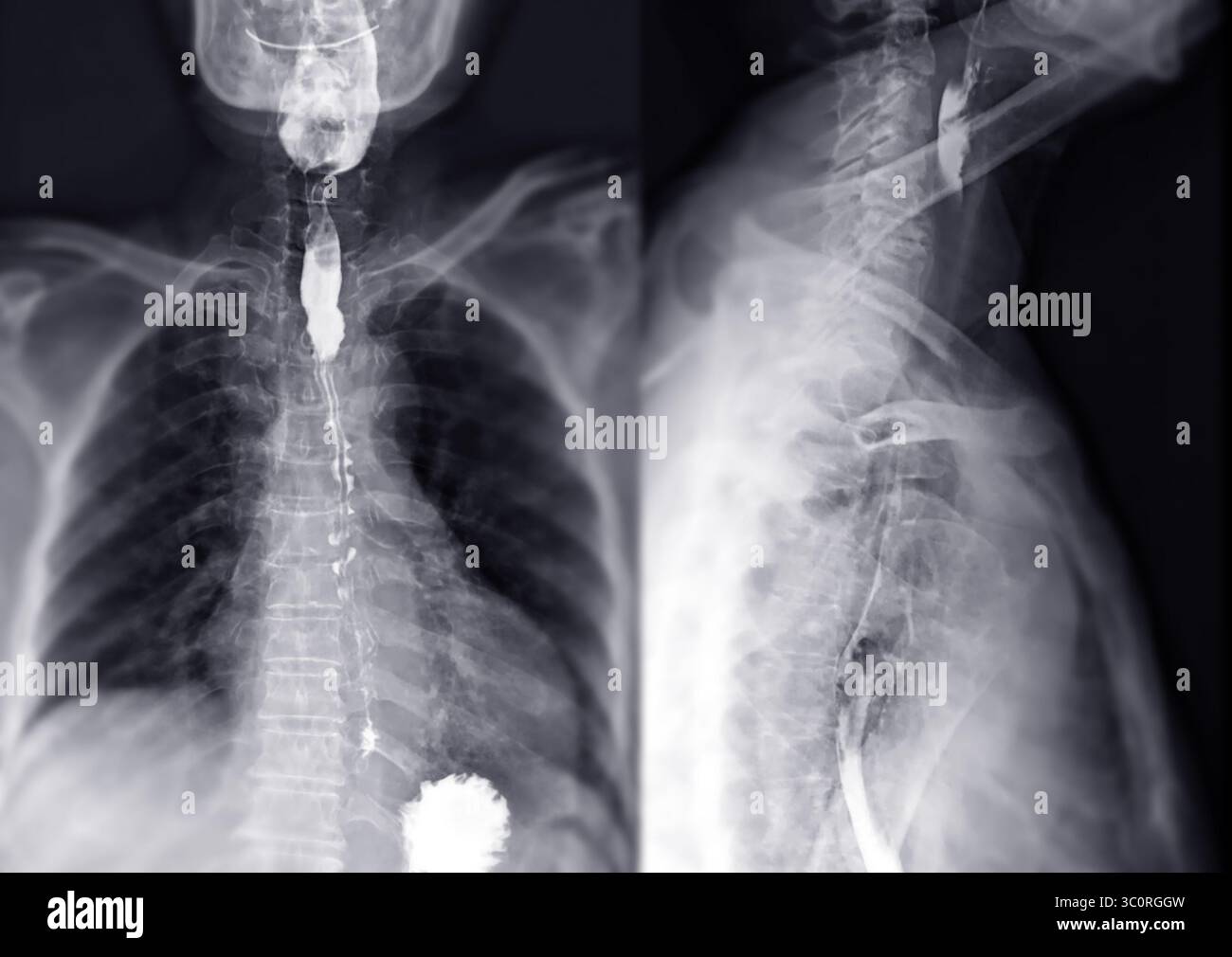 Fluoroscopic footage of a barium swallow test showing real-time ...