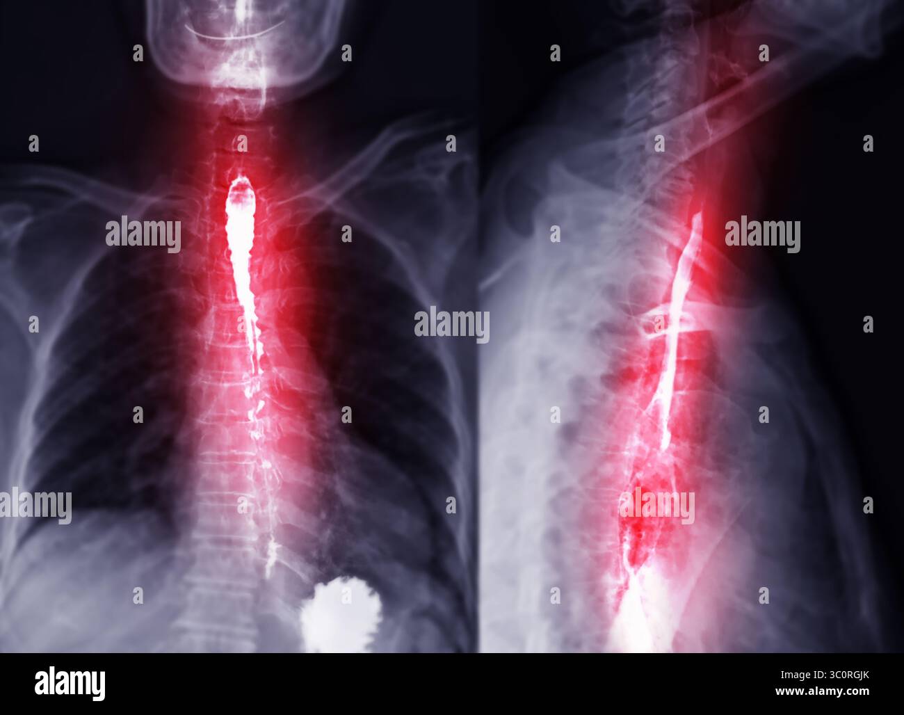 Fluoroscopic footage of a barium swallow test showing real-time ...
