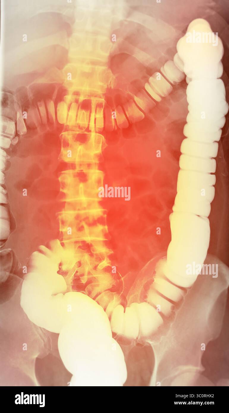 A diagnostic barium enema image showing the presence of diverticulosis ...