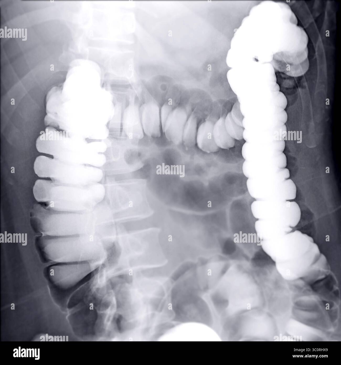 Diverticulosis of colon hi-res stock photography and images - Alamy