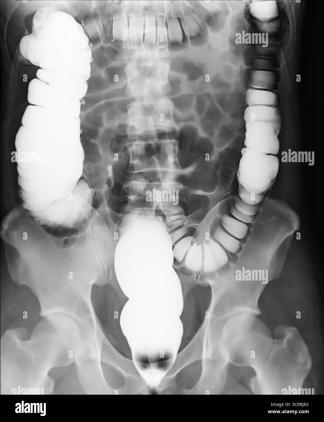 A diagnostic barium enema image showing the presence of diverticulosis ...