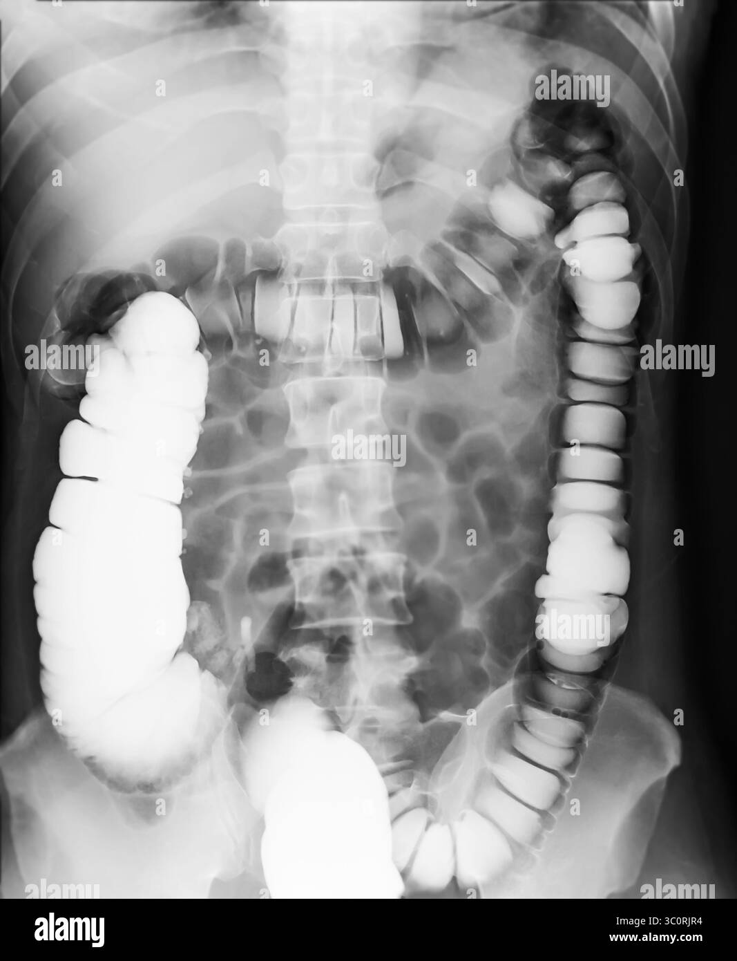 A diagnostic barium enema image showing the presence of diverticulosis ...