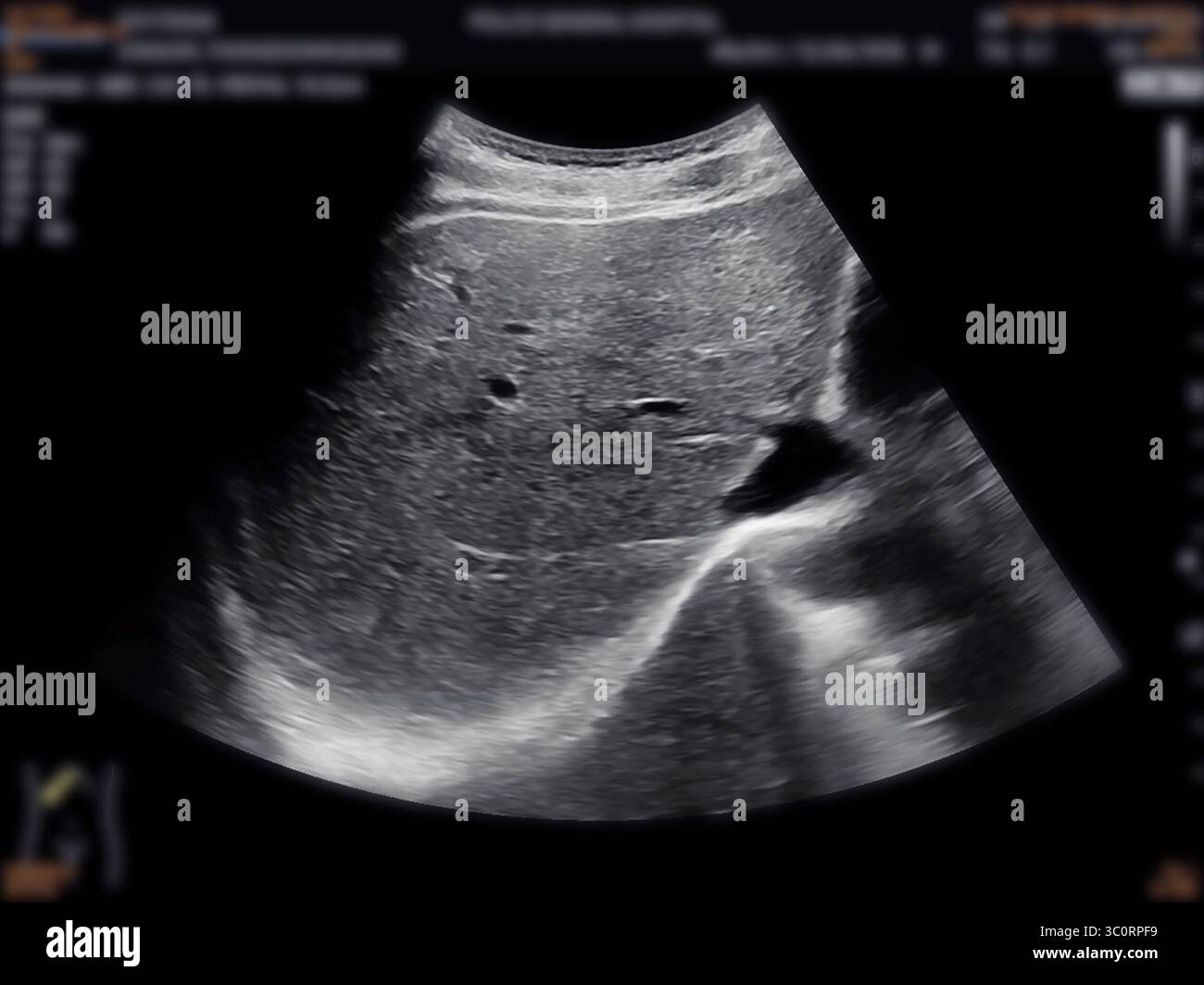 A normal ultrasound of the upper abdomen, showing healthy organs with ...